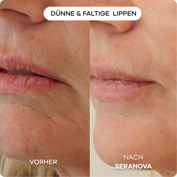 Seranova Micro Infusion System™ | Seranova DACH